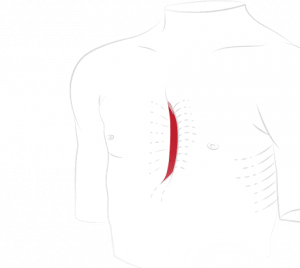 Pectus Excavatum - Neumark Lung & Chest Surgical Centre