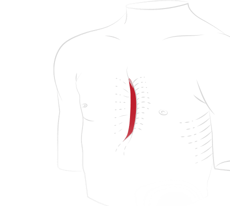 Pectus Excavatum - Neumark Lung & Chest Surgical Centre
