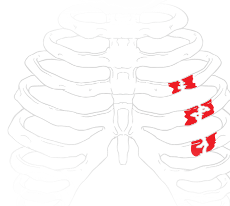Rib Fracture - Neumark Lung & Chest Surgical Centre