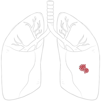 Lung Volume Reduction - Neumark Lung & Chest Surgical Centre