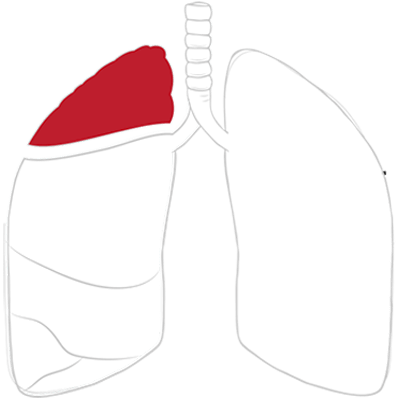 Lung Volume Reduction - Neumark Lung & Chest Surgical Centre