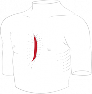 Pectus Excavatum - Neumark Lung & Chest Surgical Centre