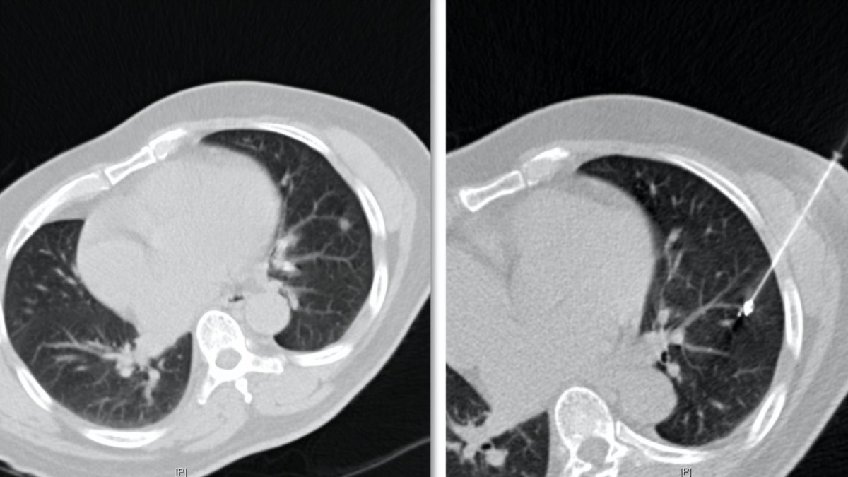 Minimally Invasive CT-Guided Lung Biopsy & VATS Singapore