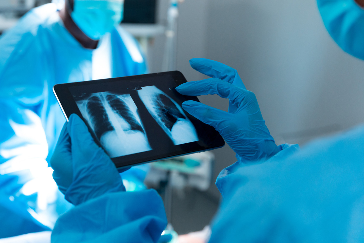 Lung Cancer Wedge Resection for Early-Stage Lung Conditions