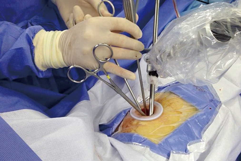 U-VATS Revolutionises Benign Lung Tumour Treatment