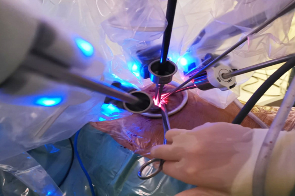 U-VATS Revolutionises Benign Lung Tumour Treatment