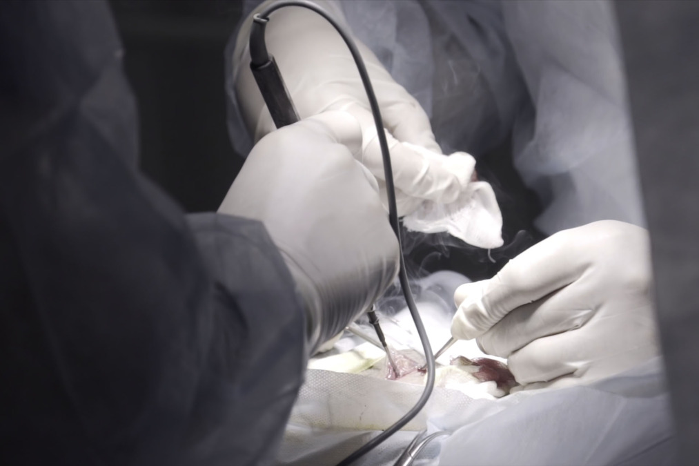 Video-Assisted Thoracic Surgery Singapore | VATS Surgery