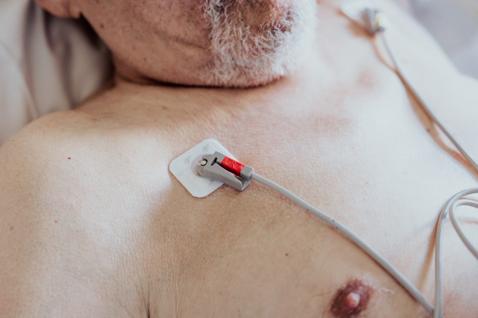 Anterior Mediastinal Mass: Symptoms & Treatment in Singapore