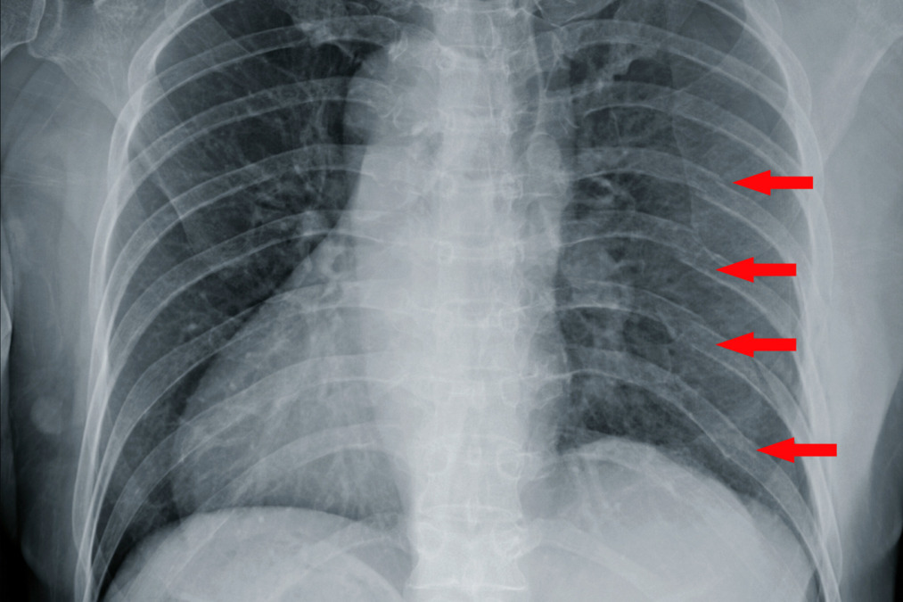 Broken Ribs Treatment Expert Thoracic Surgery For Rib Fractures