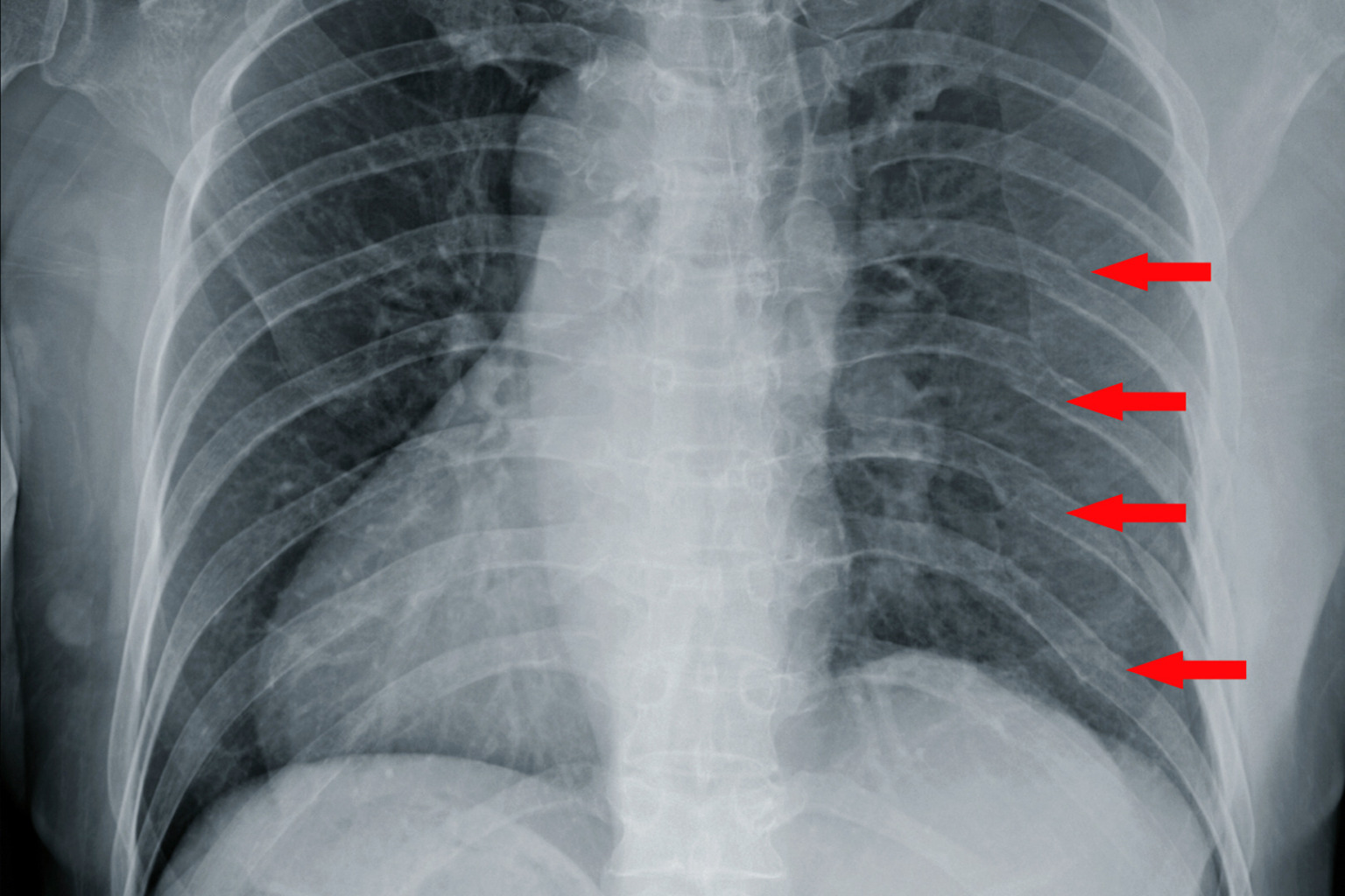 Broken Ribs Treatment: Expert Thoracic Surgery for Rib Fractures