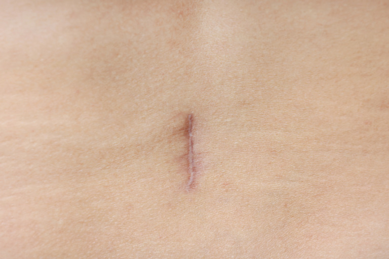 Broken Ribs Treatment: Expert Thoracic Surgery for Rib Fractures