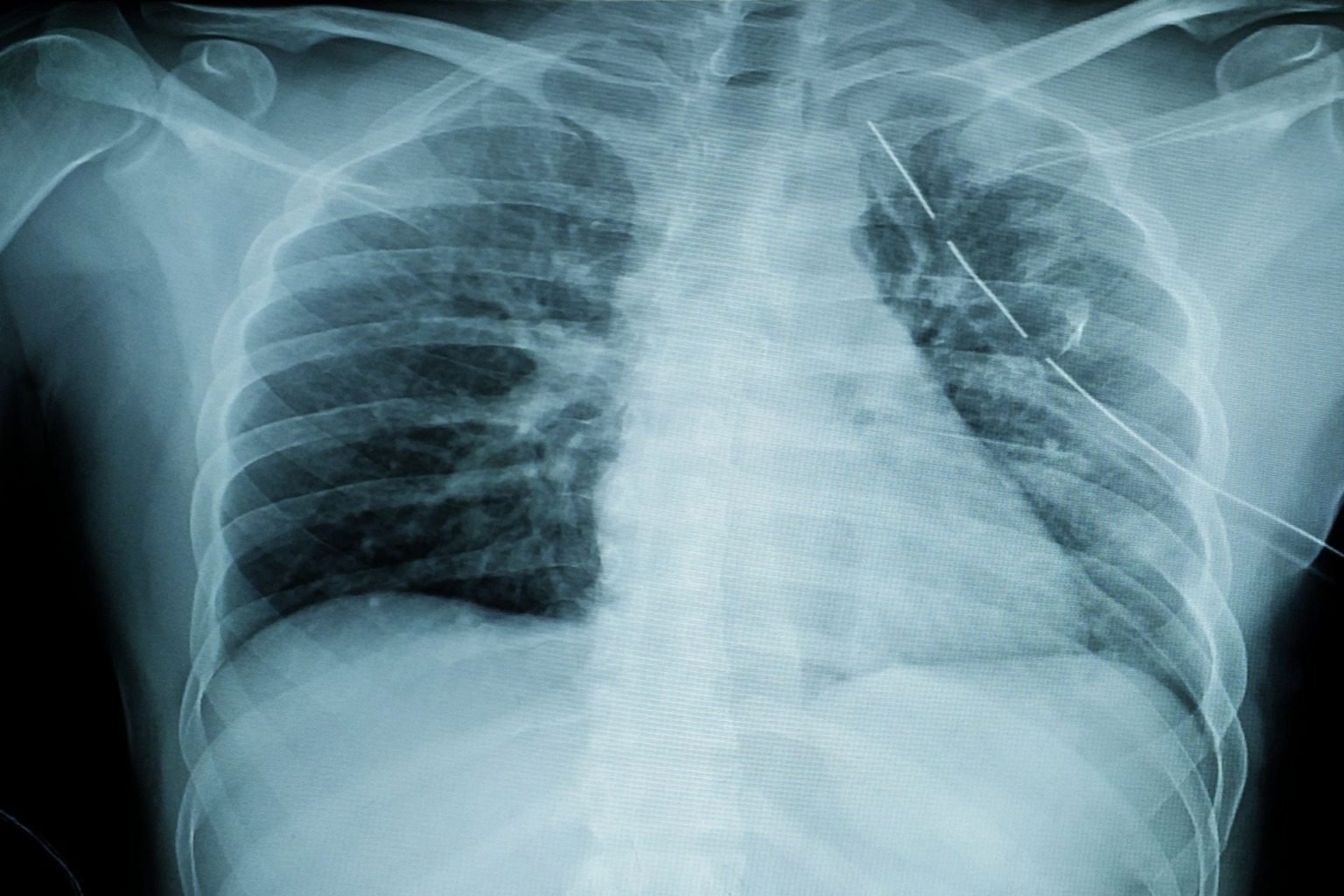 Neumark Treatment for Rib Fracture without Trauma with Internal Rib ...