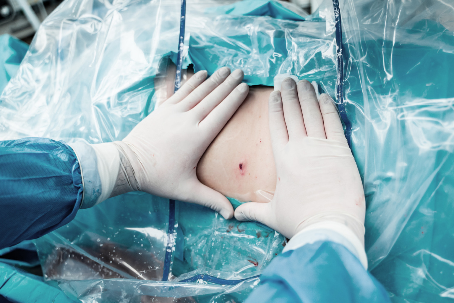 Neumark Treatment for Chronic Rib Fractures with Internal Rib Fixation