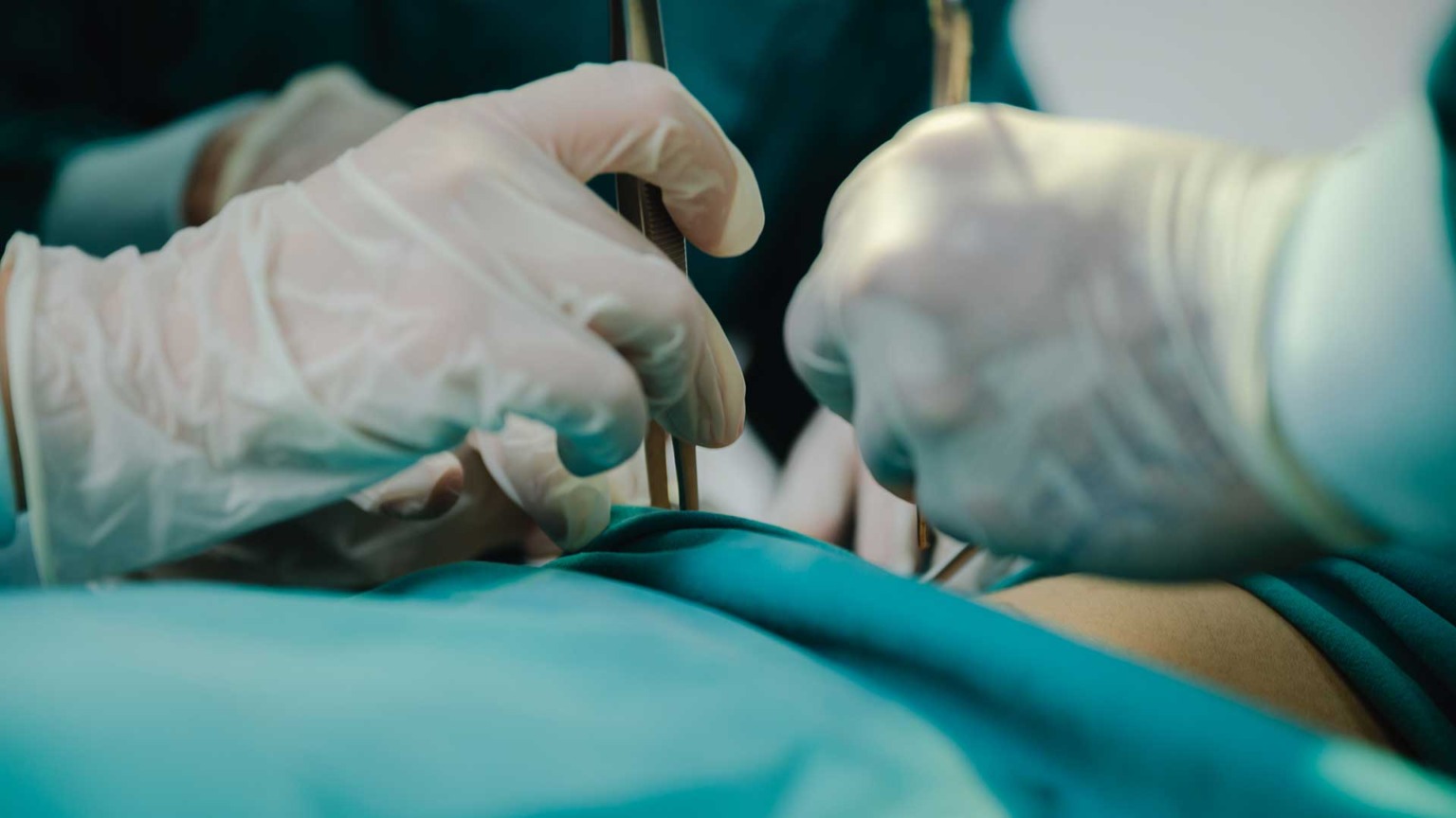 Understanding Loculated Pneumothorax: Causes, Symptoms, and Treatment