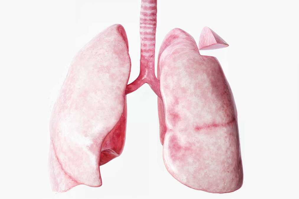 Lung Cancer Wedge Resection for Early-Stage Lung Conditions