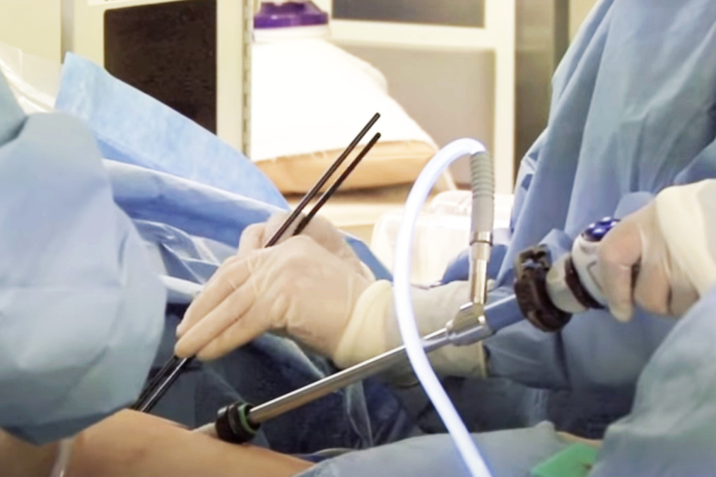 Minimally Invasive Lung Volume Reduction Surgery