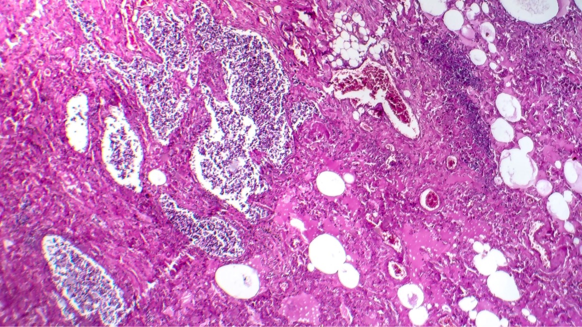 Early Lung Cancer Screening for Women in Singapore