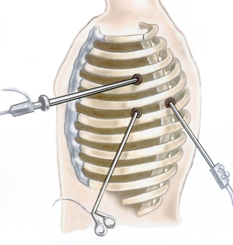 Sweaty Palms Operation in Singapore