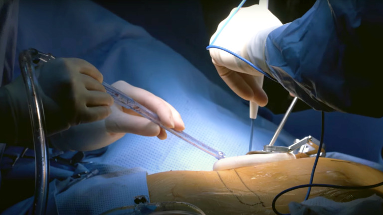 Types of Lung Surgery for Lung Cancer